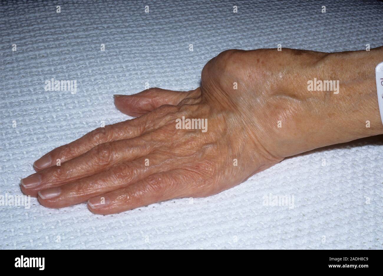 Poignet arthritiques. Main d'un patient atteint de rhumatisme ...