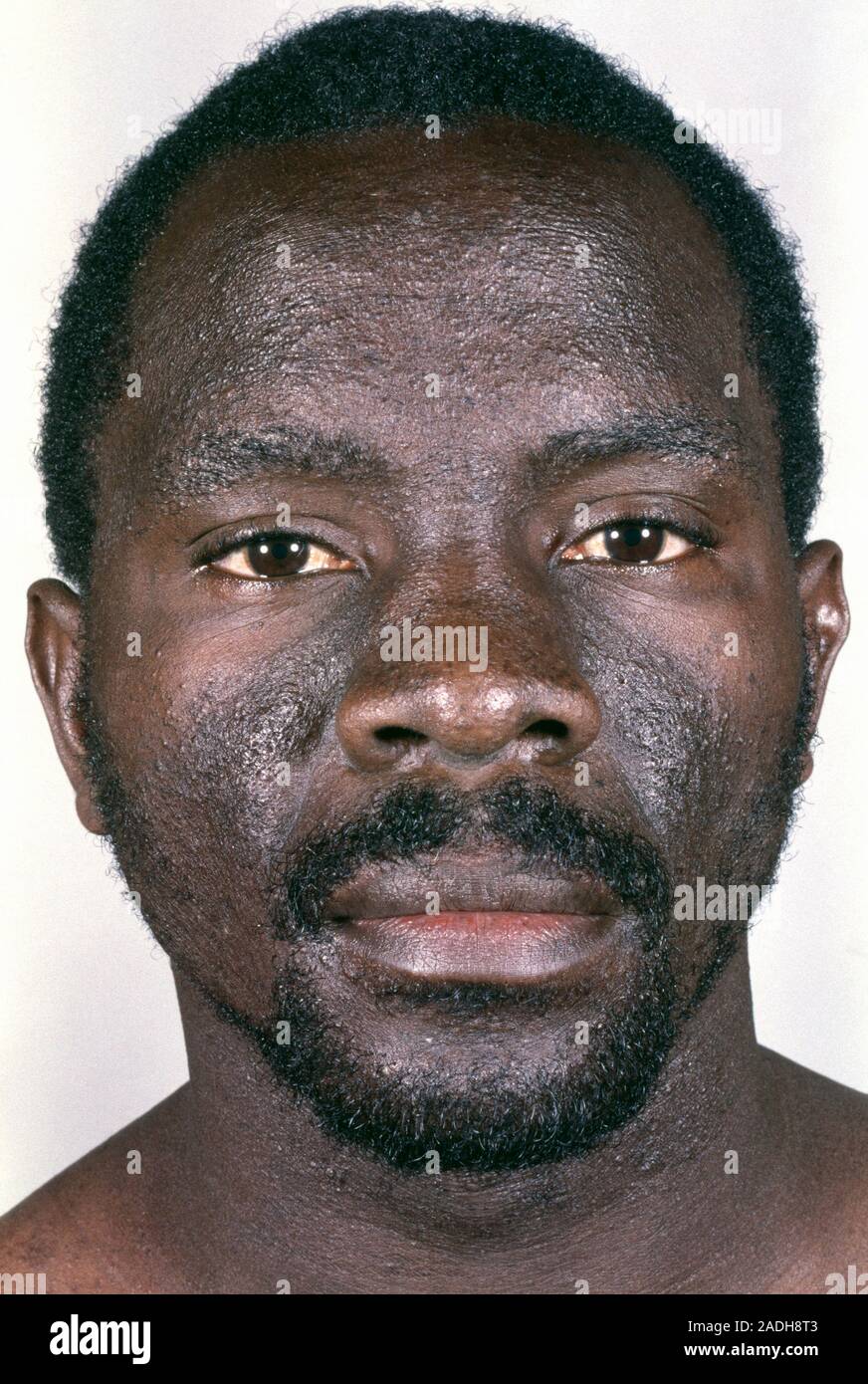 Sida l'homme avec une dermatite. Visage de l'homme montrant la ...