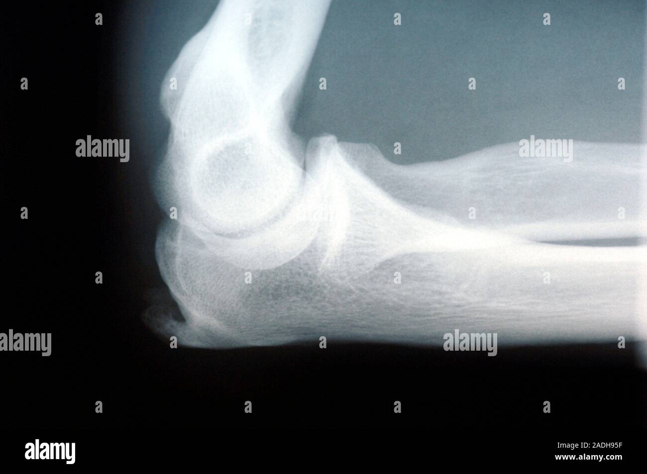 Le Bursitis du coude. X-ray du bras d'un homme de 59 ans avec olecranon ...