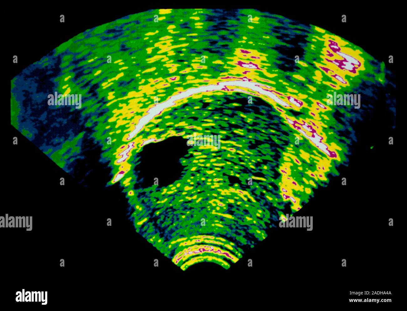 Kyste du foie. L'image échographique couleur de kyste vu dans le foie d ...