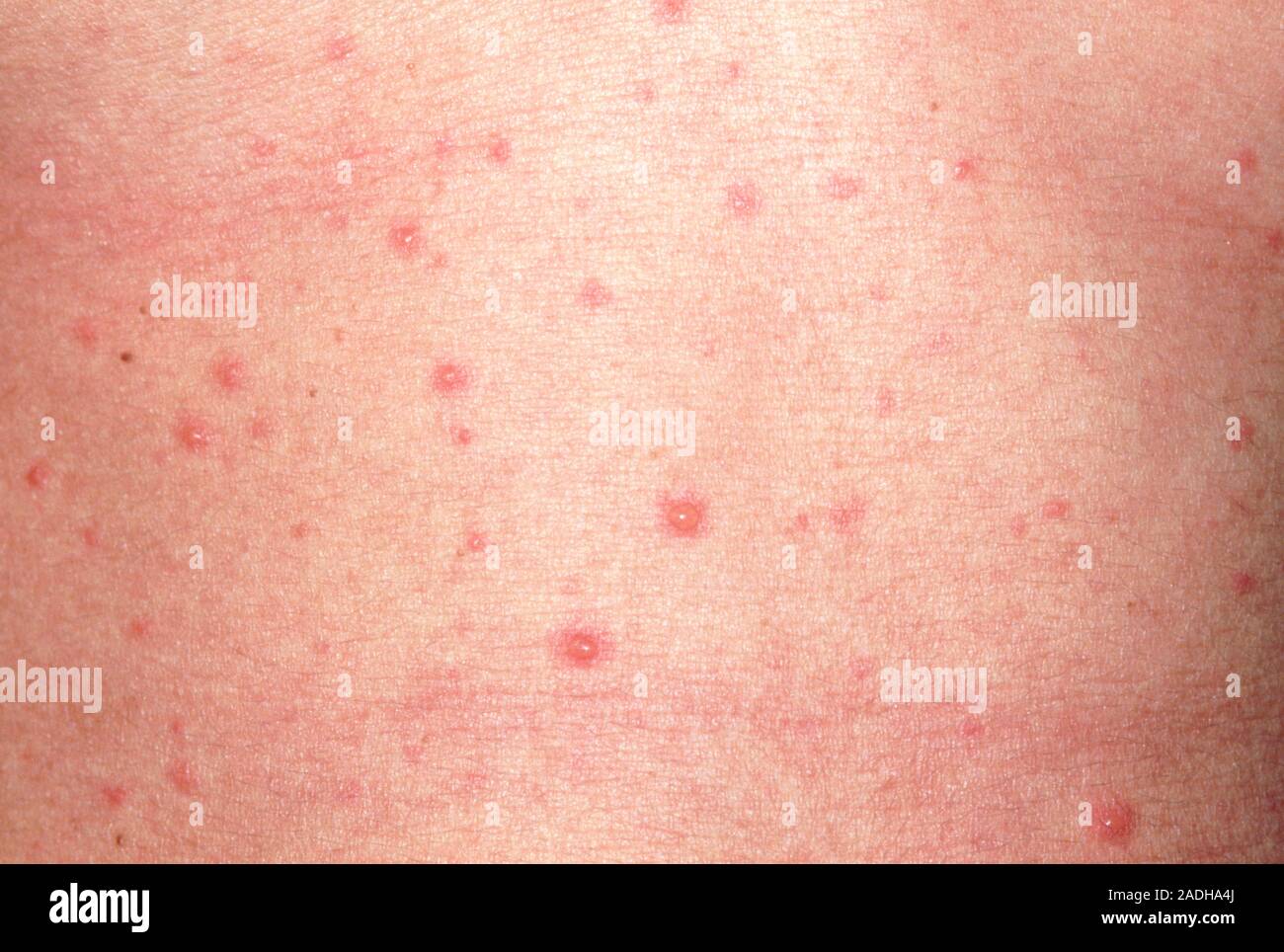 La varicelle. Close-up de vésicules (lésions) sur la peau d'un patient ...