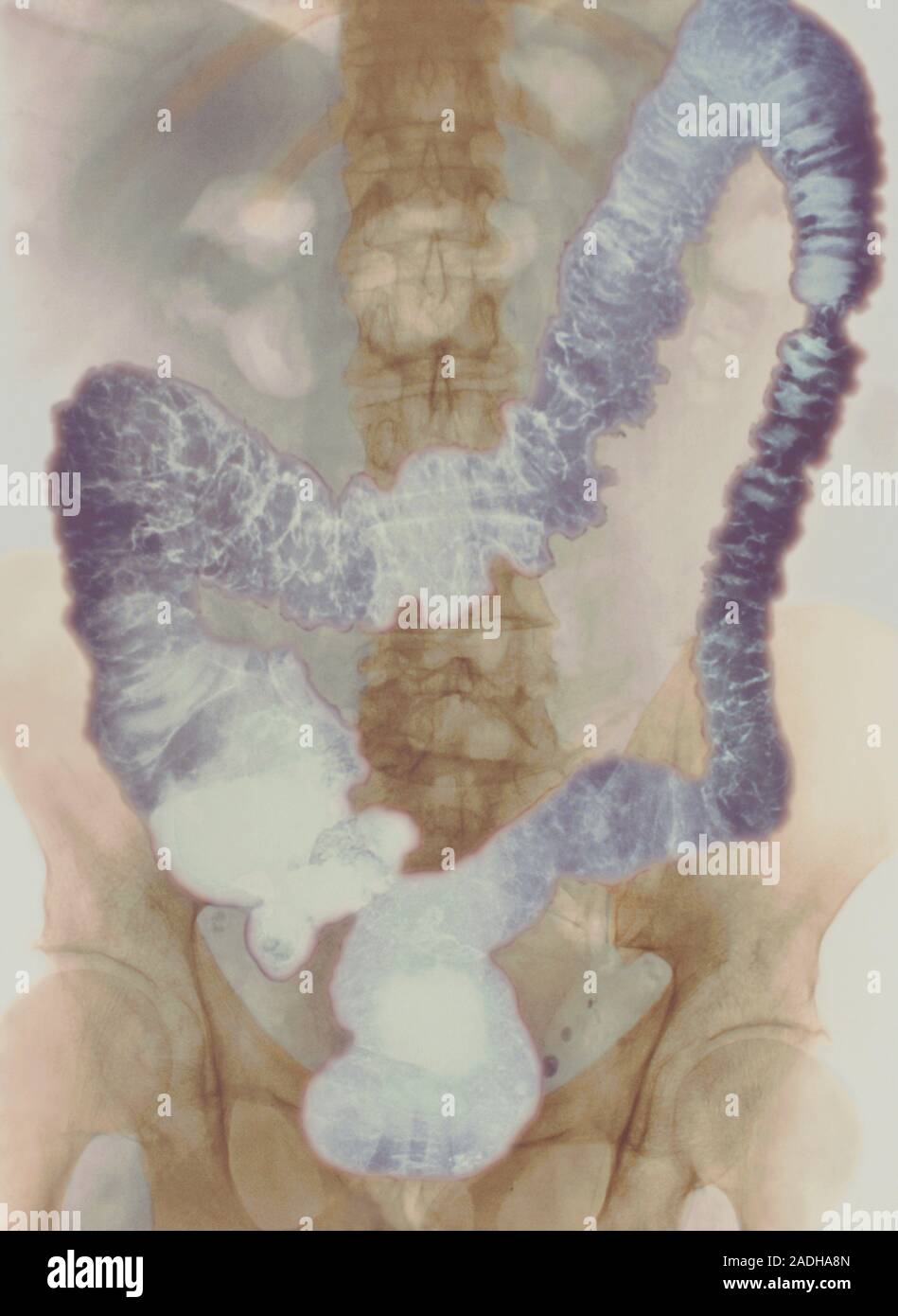 La colite ulcéreuse. Repas baryté couleur du côlon (bleu) d'un patient ...