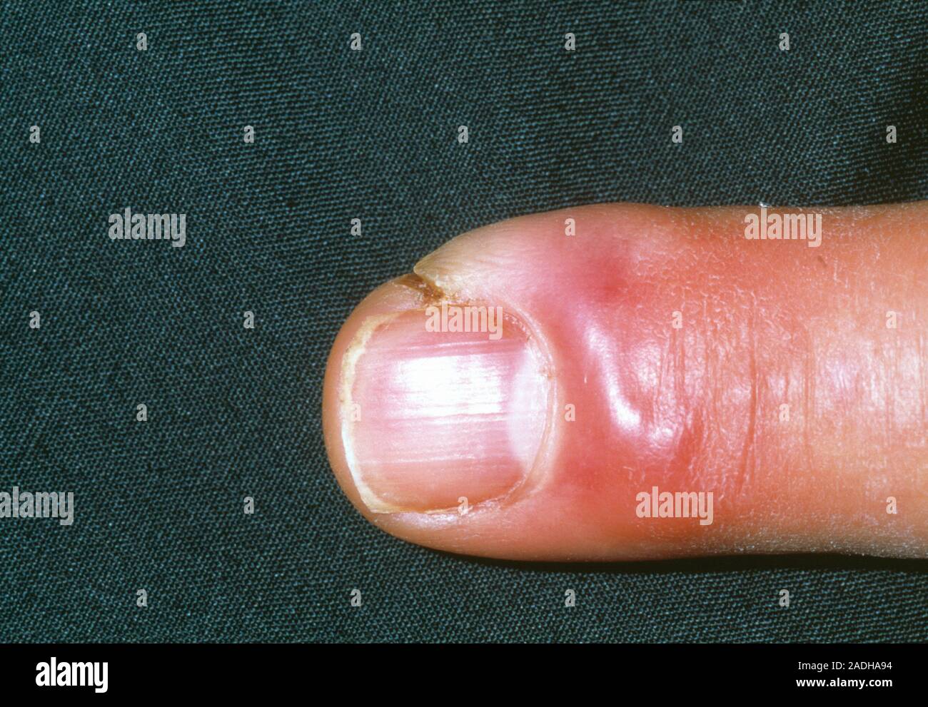 La cellulite sur la pointe d'une 64 year old man's finger. La cellulite ...