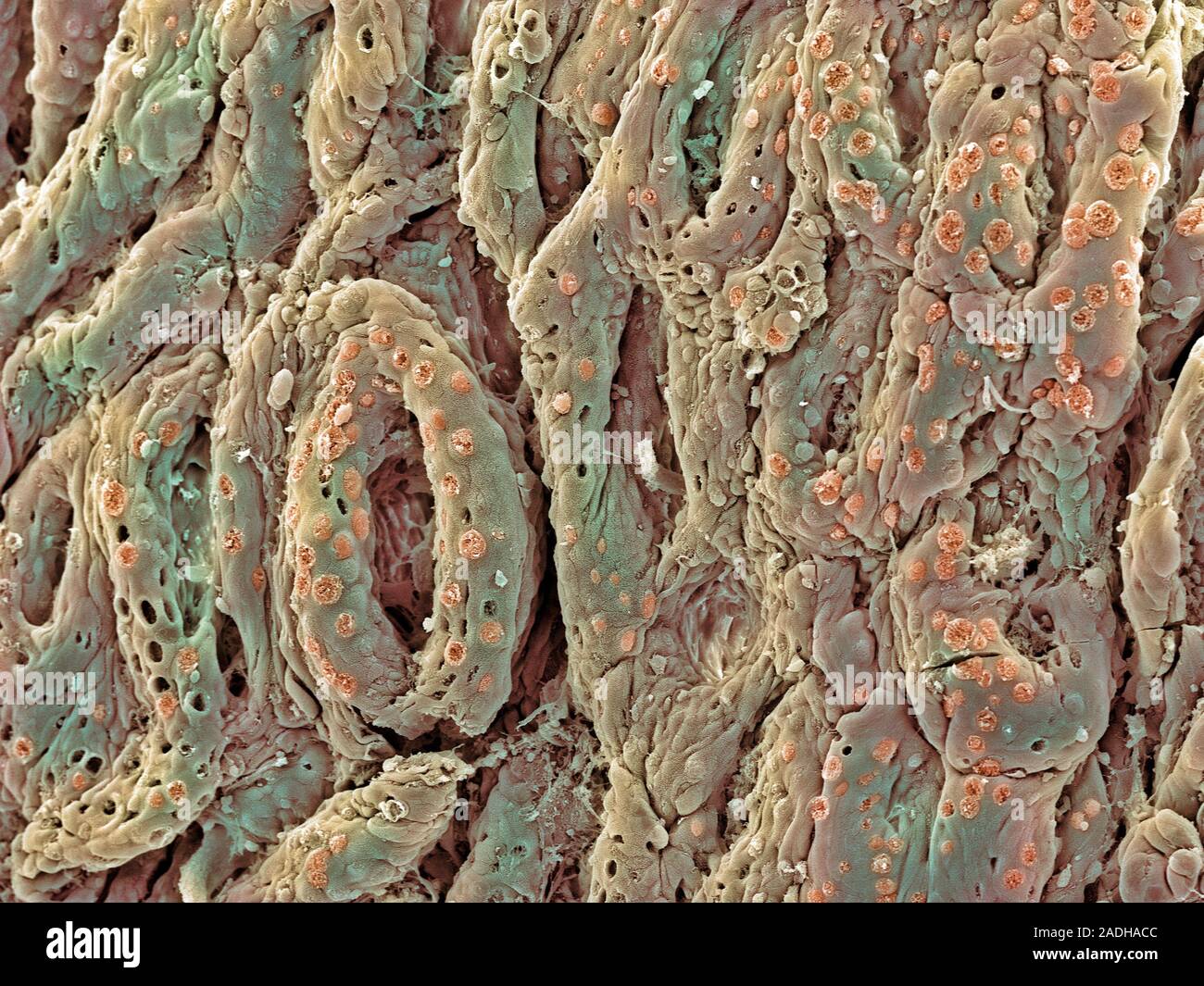 La colite ulcéreuse. Couleur de l'analyse des électrons ...