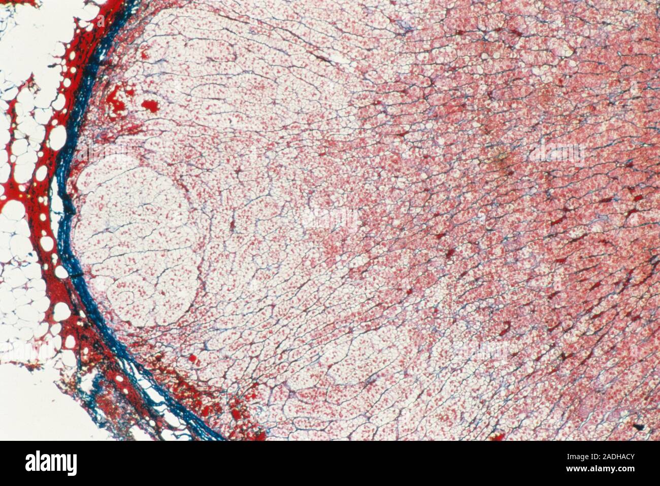 Le syndrome de Cushing. Microphotographie lumière d'une section au ...