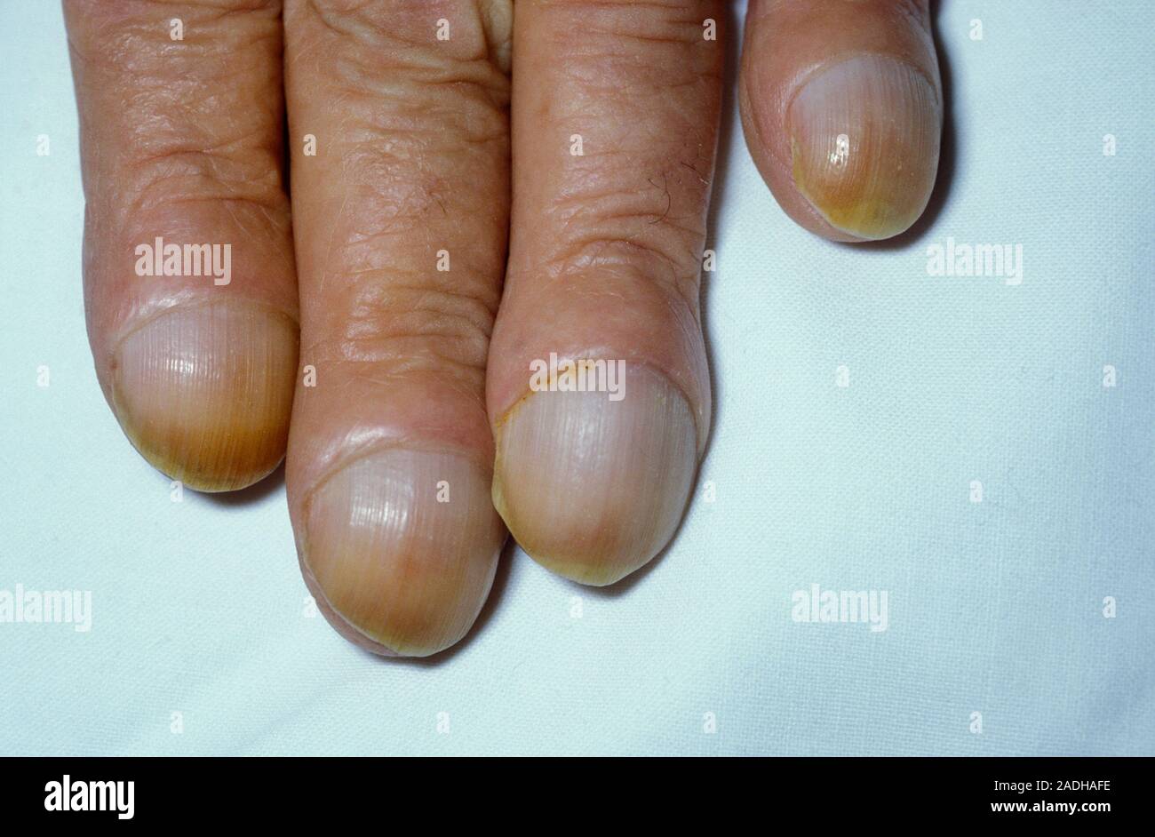L'ascidie les doigts. Clubbing (acropachy) des doigts due au cancer du poumon. Le bout des ...