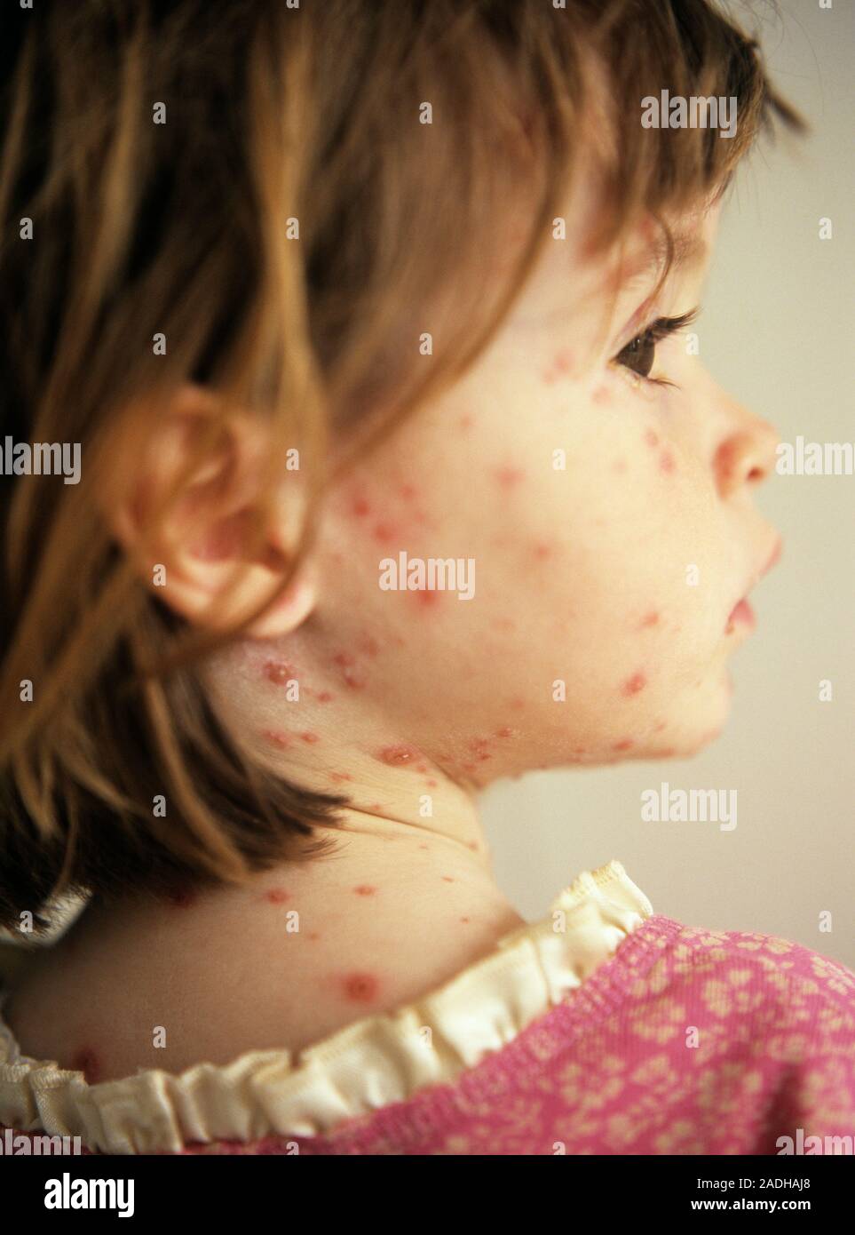 Parution du modèle. La varicelle. Jeune fille avec la varicelle (ou la ...