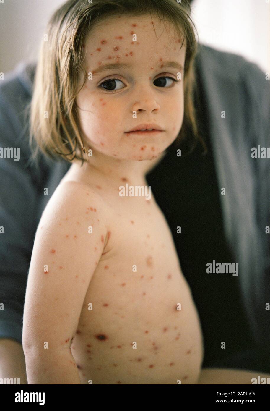 Parution du modèle. La varicelle. Jeune fille avec la varicelle (ou la ...