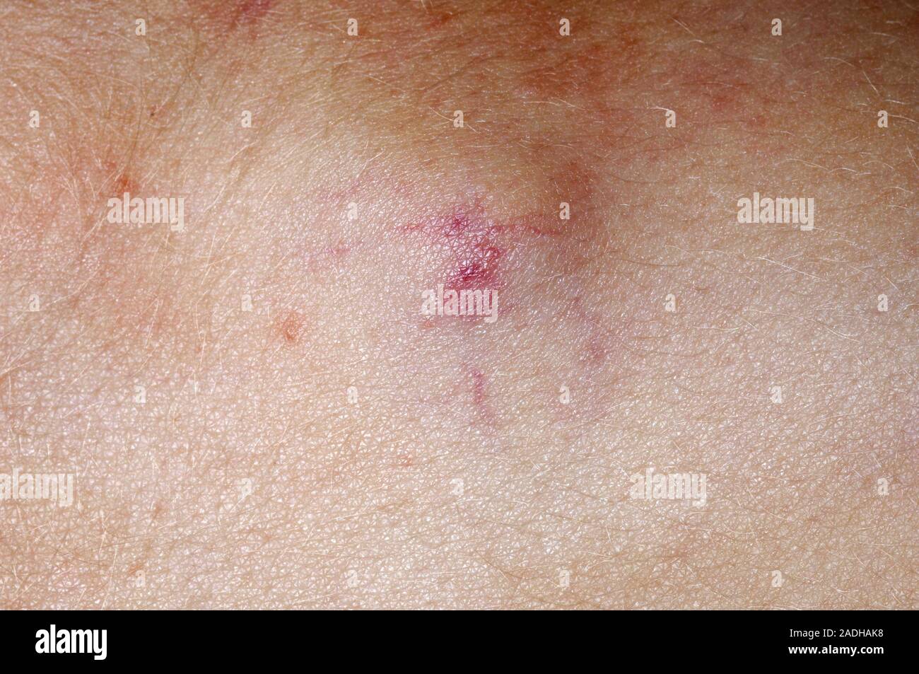 Calcinosis sous-cutanée. Des nodules calcifiés, sur le dos d'un garçon ...