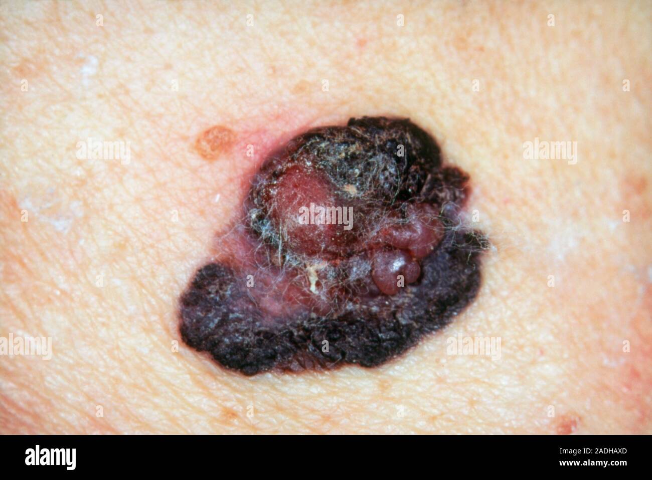 Le mélanome malin de la peau du patient. Tumeur maligne hautement de la mélanine, pigment de la ...