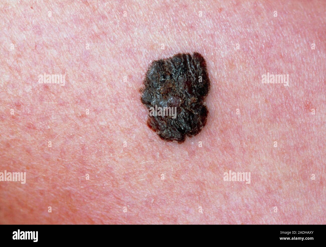 Un mélanome malin, un cancer de la peau malignes les mélanocytes ...