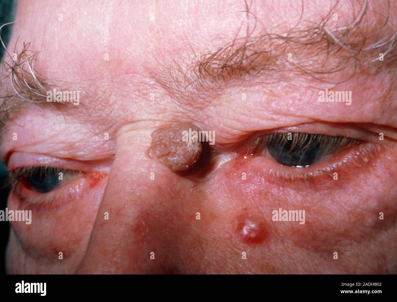 Grande verrue séborrhéique (sur le nez) et un plus petit un carcinome ...