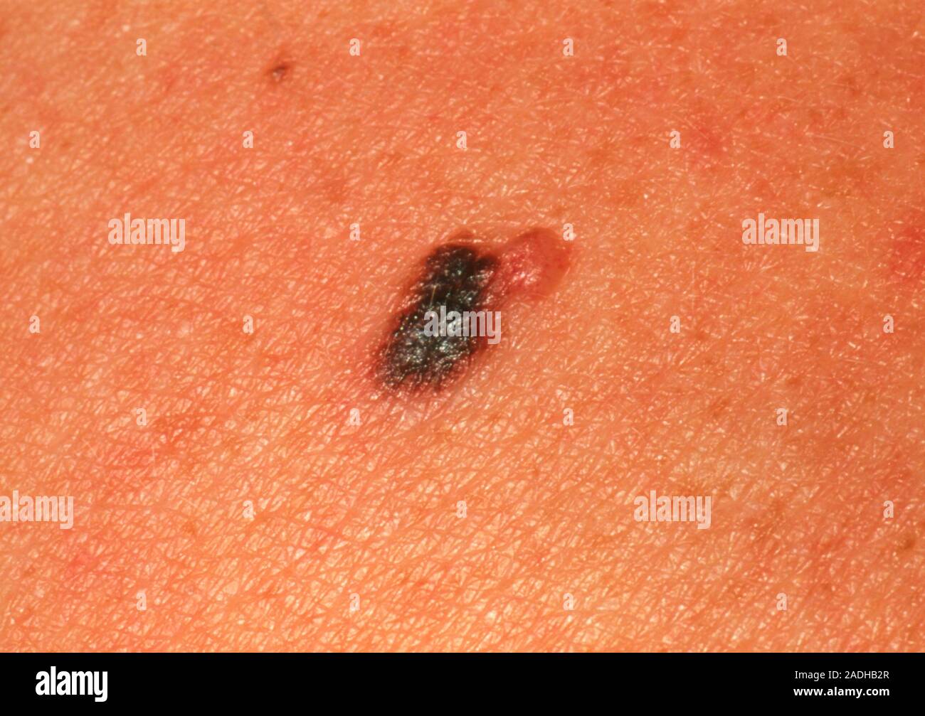 Les mélanomes. Close-up d'un mélanome malin cancer de la peau sur la ...