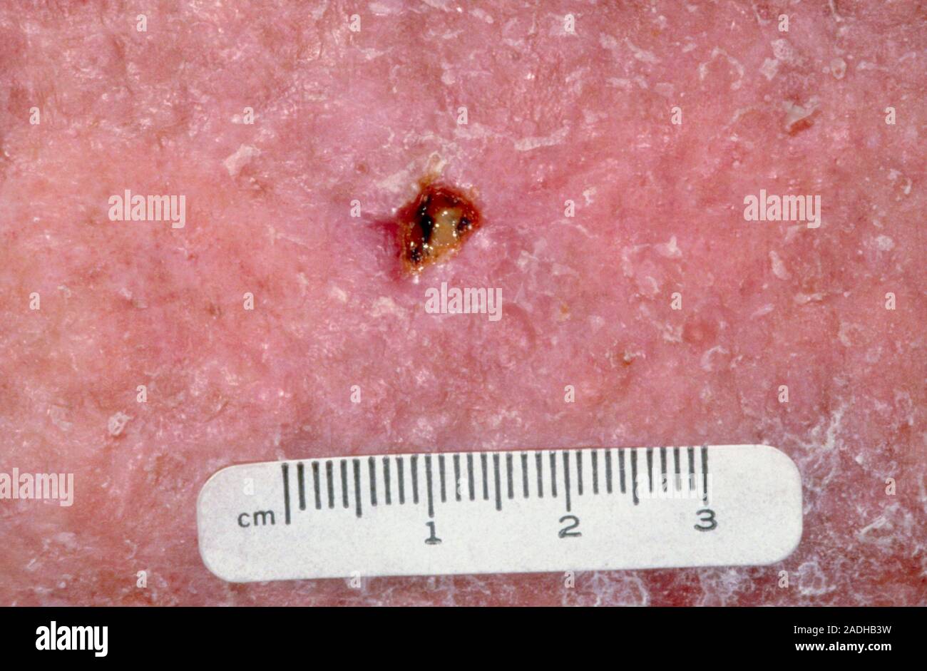 Le carcinome spinocellulaire. Close-up d'un carcinome spino-cellulaire ...
