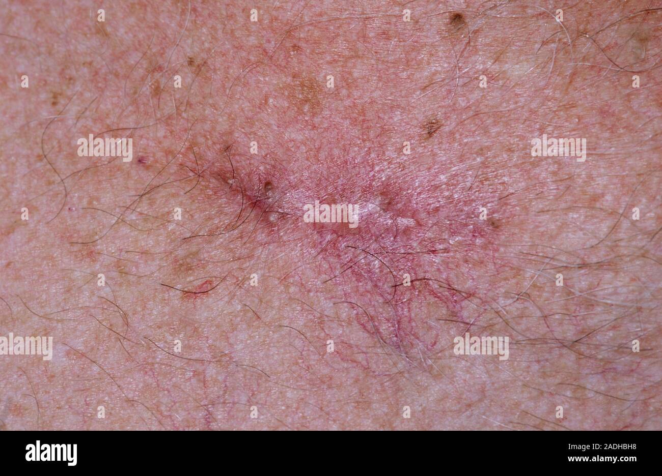 Cancer de la peau. Le carcinome basocellulaire (CBC), ou ulcus rodens ...