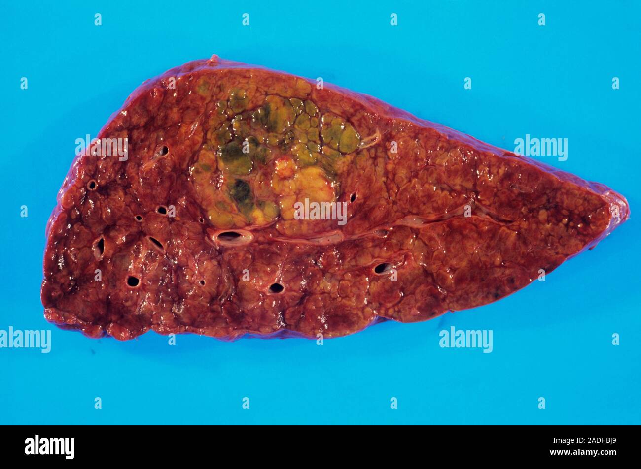 Le cancer du foie. Spécimen d'une brute avec du foie cancer du foie et ...