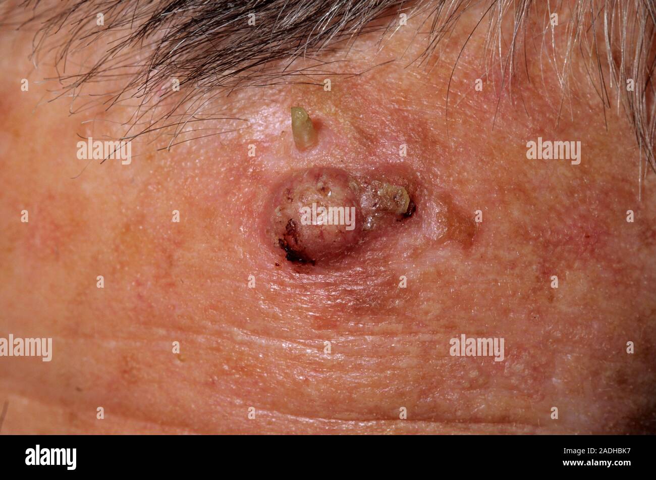 Cancer de la peau. Le carcinome basocellulaire (CBC), ou ulcus rodens ...