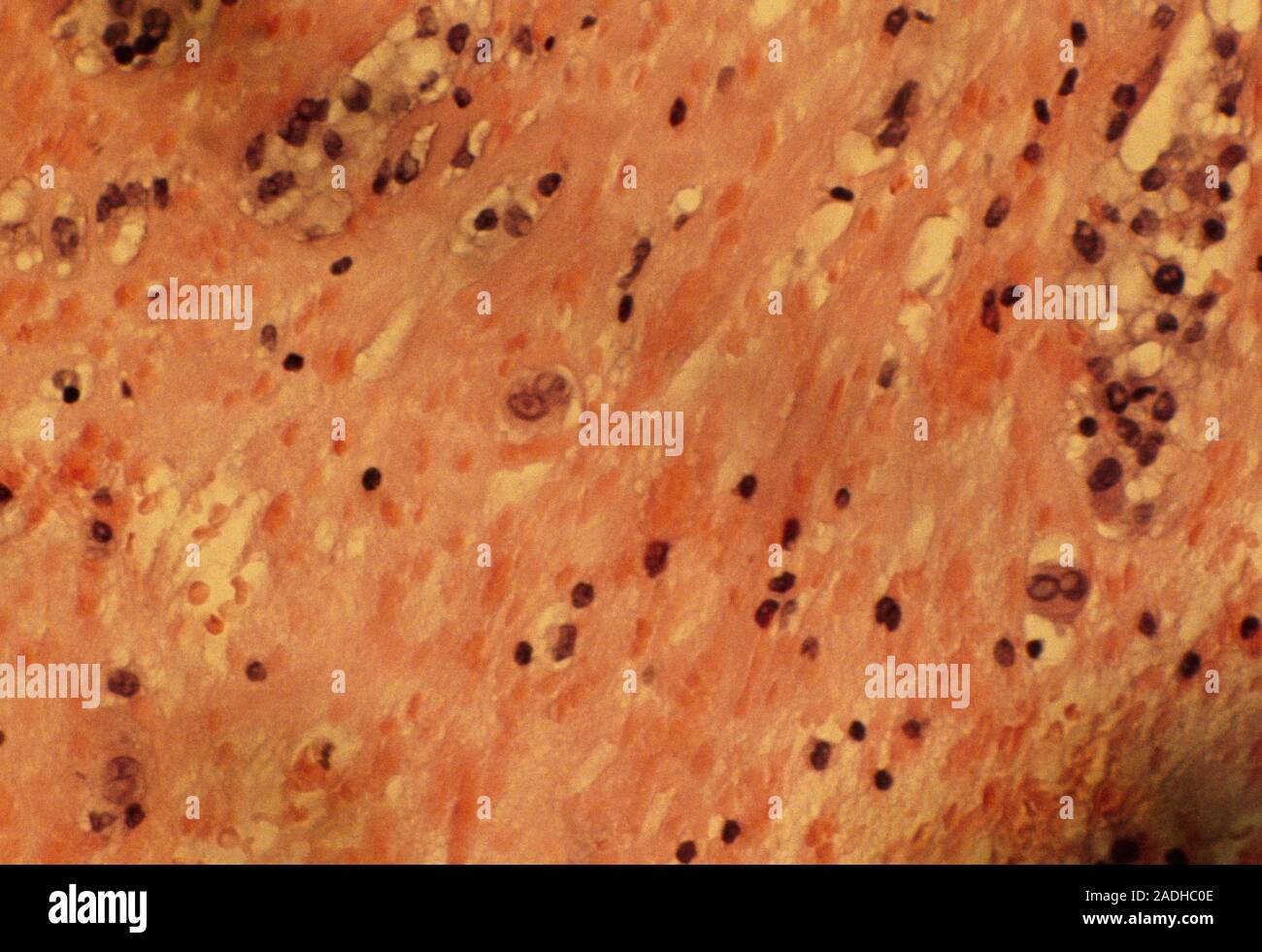 Micrograph Light d'un pathologiste, biopsie montrant des signes de la ...