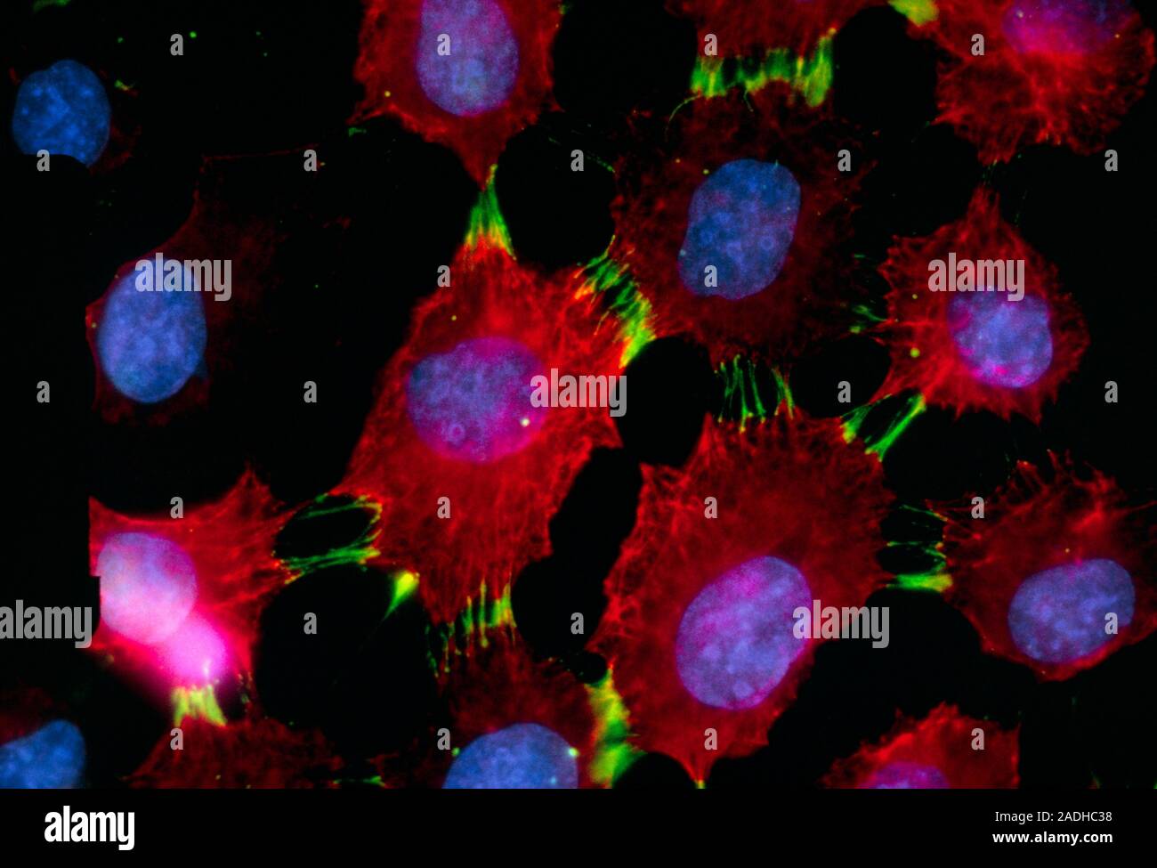 Le cancer de la vessie. Micrograph light par immunofluorescence des ...