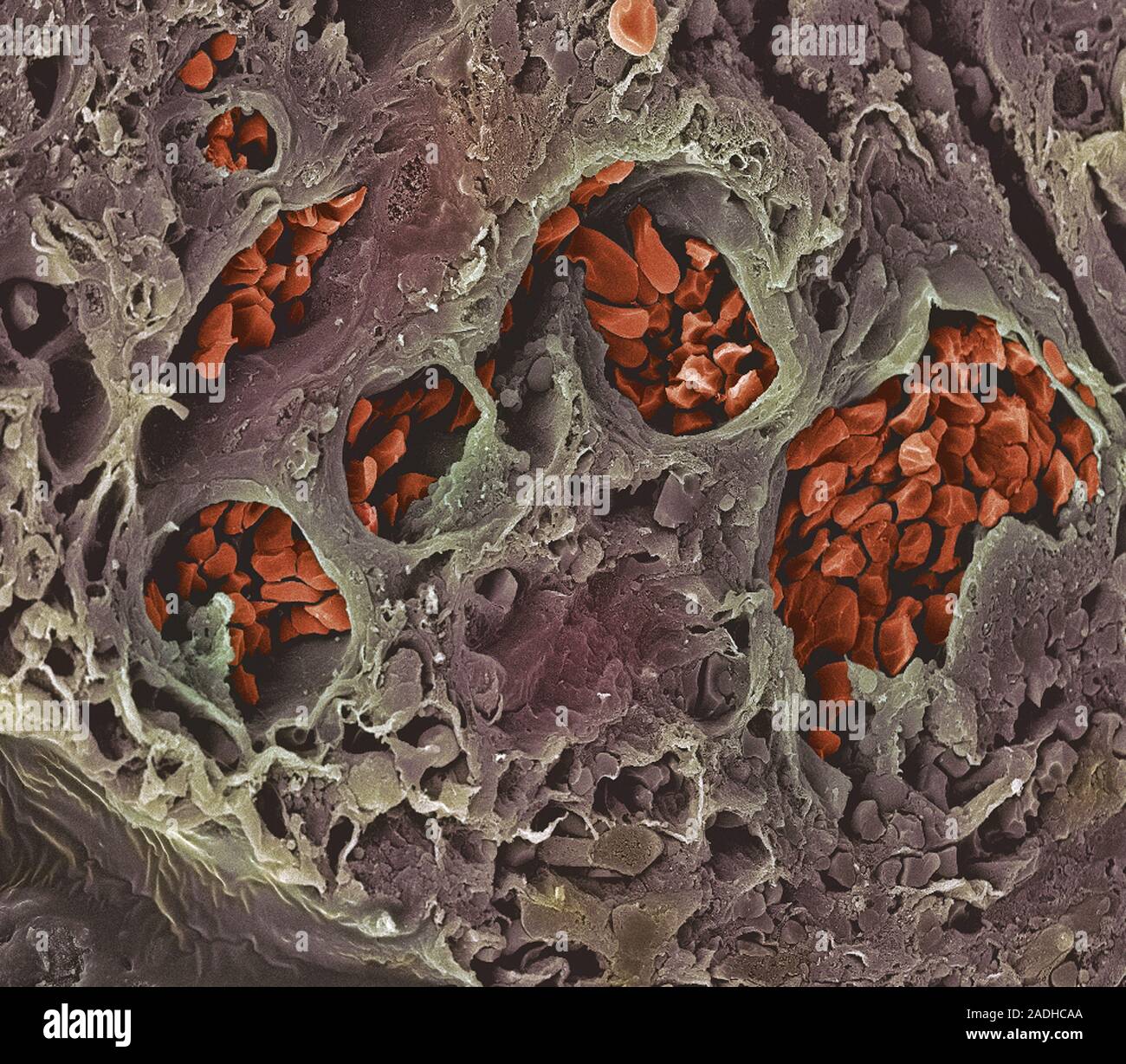 Le cancer du côlon. Couleur de l'analyse des électrons ...