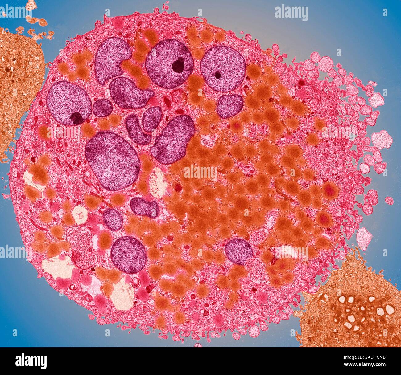 Des cellules de cancer de la vessie. Micrographe de couleur (TEM) d'une ...