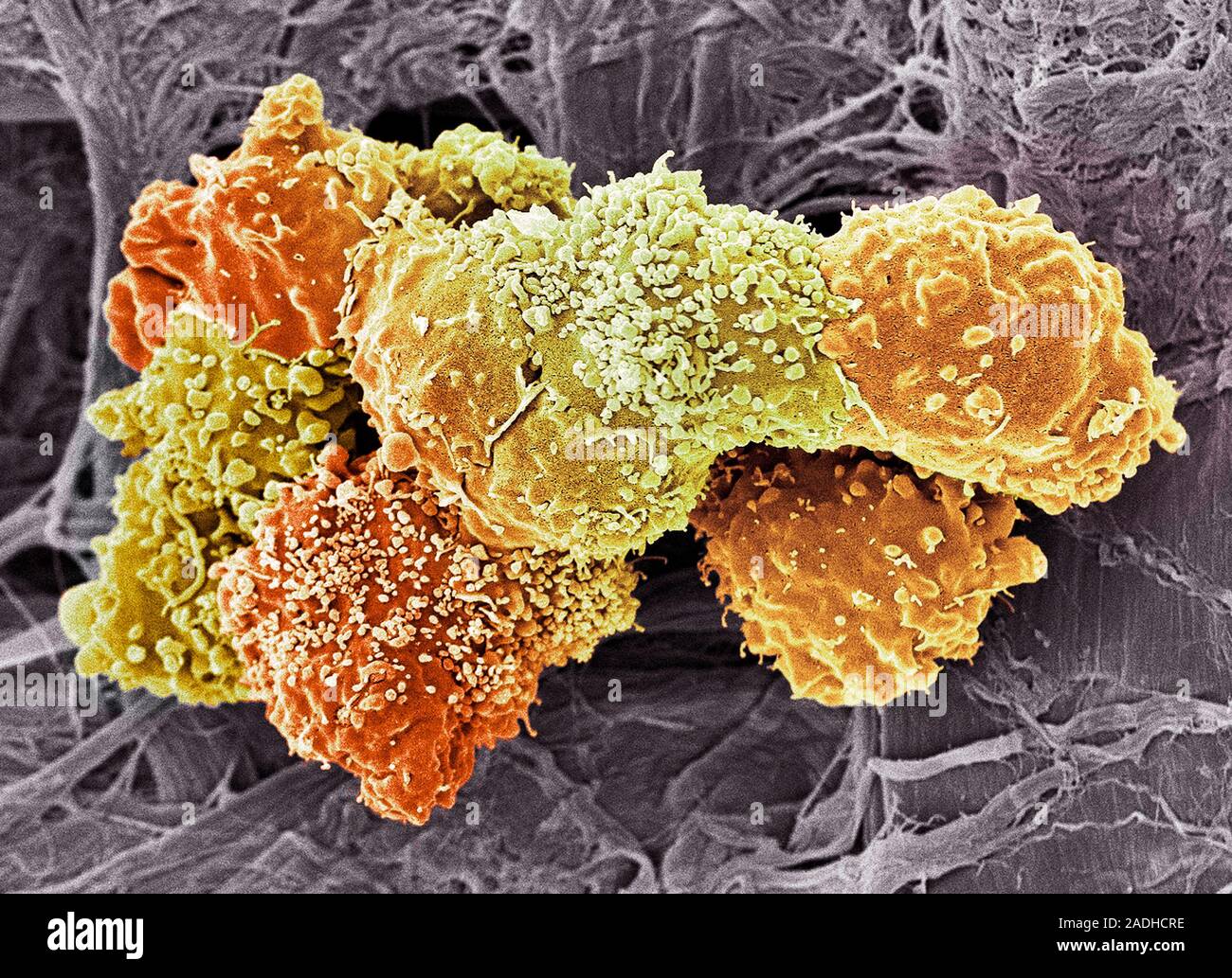 Les cellules de cancer de tératome. Couleur de l'analyse des électrons ...