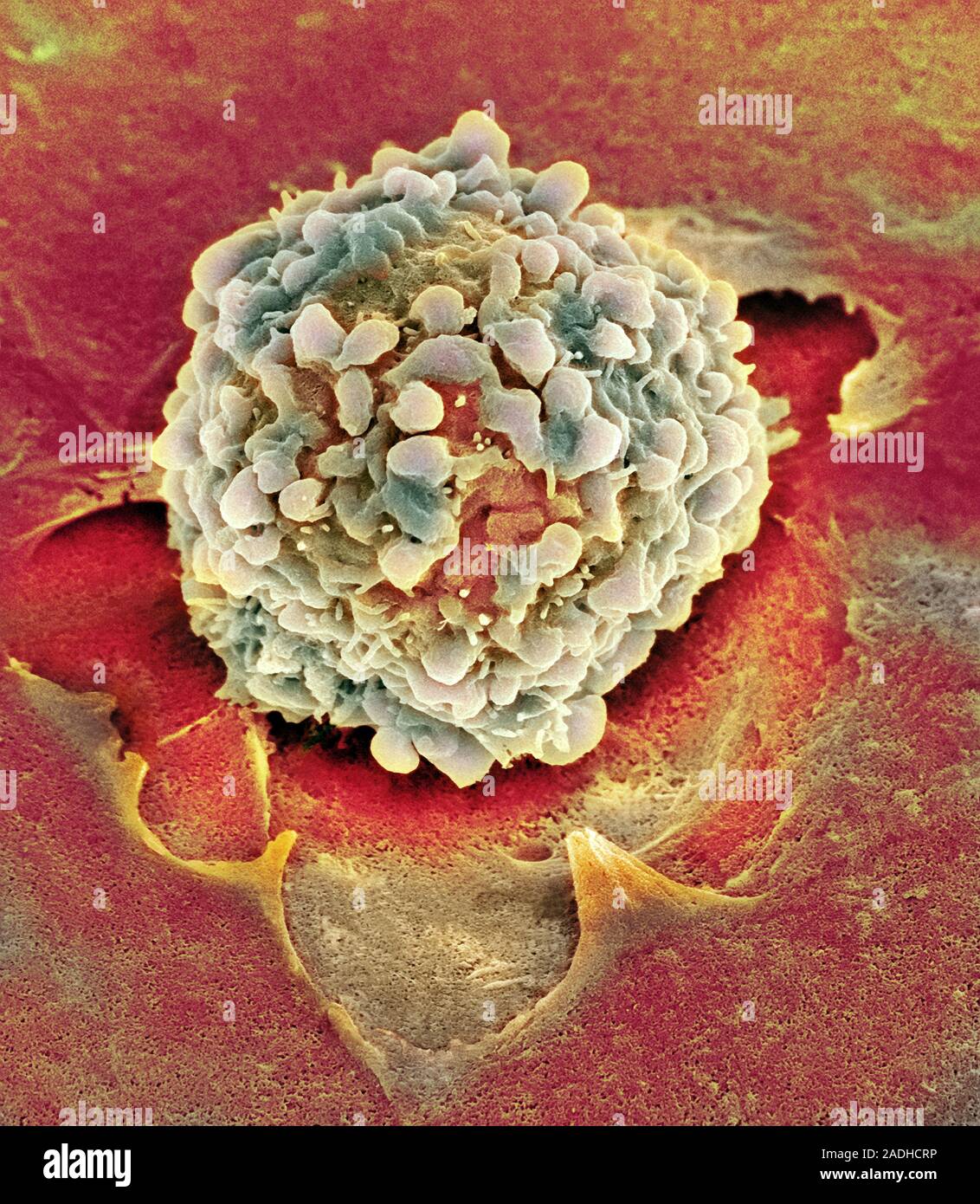 Les cellules du cancer du rectum. Couleur de l'analyse des électrons ...