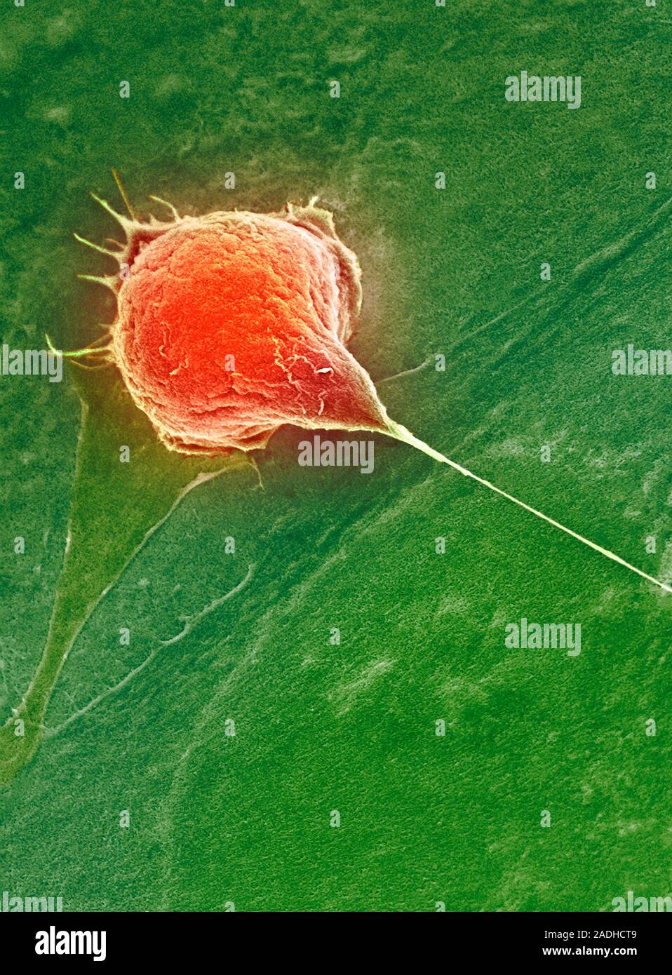 Des cellules de cancer de la vessie. Couleur de l'analyse des électrons ...