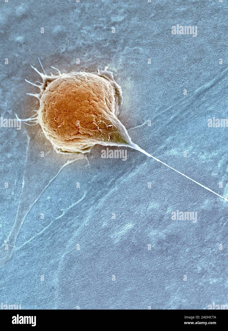 Des cellules de cancer de la vessie. Couleur de l'analyse des électrons ...