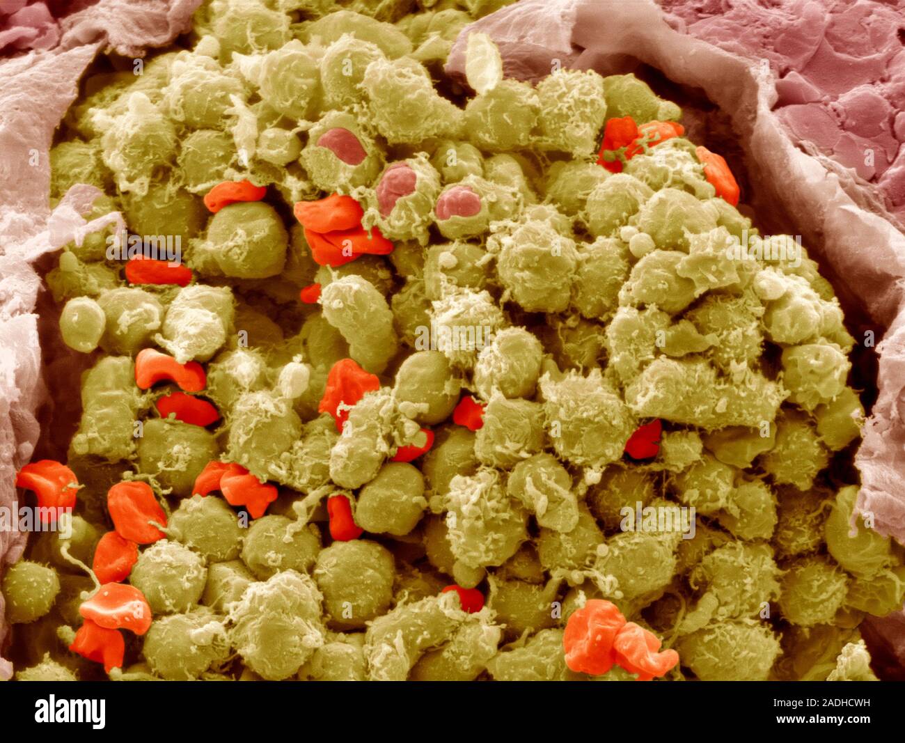 Le lymphome. Couleur de l'analyse des électrons Microphotographie (SEM ...