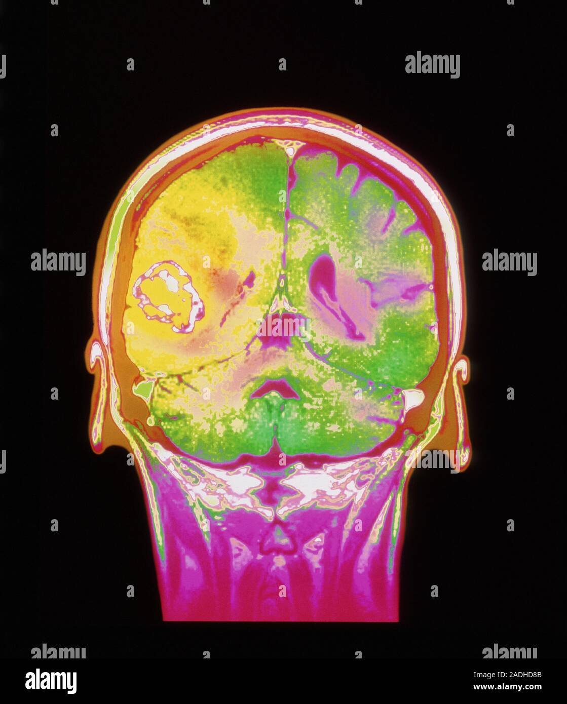 Tumeur au cerveau. L'imagerie par résonance magnétique de couleur (IRM) d'une section frontale à ...