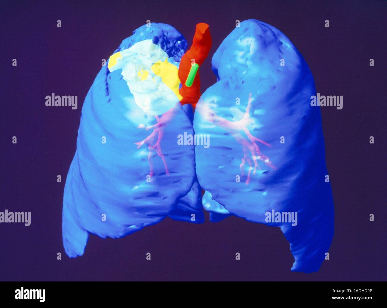Le cancer du poumon. Trois dimensions couleur scan tomodensitométrie ...