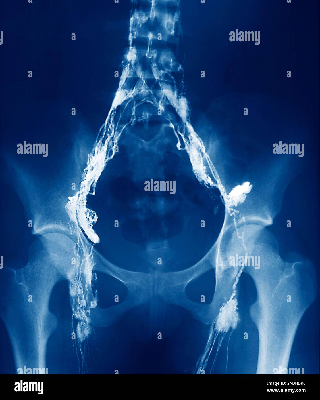 Le lymphome. Lymphangiogram couleur X-ray de qualités (blanc) dans l ...