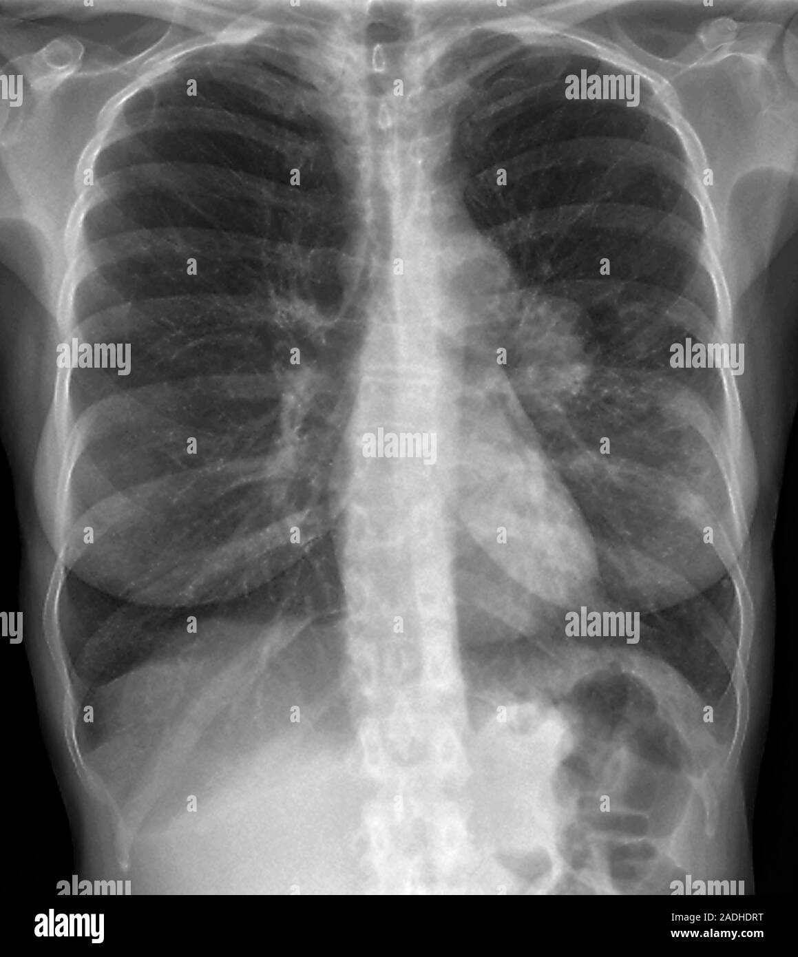 Le cancer du poumon. X-ray montrant le cancer dans le poumon gauche de ...