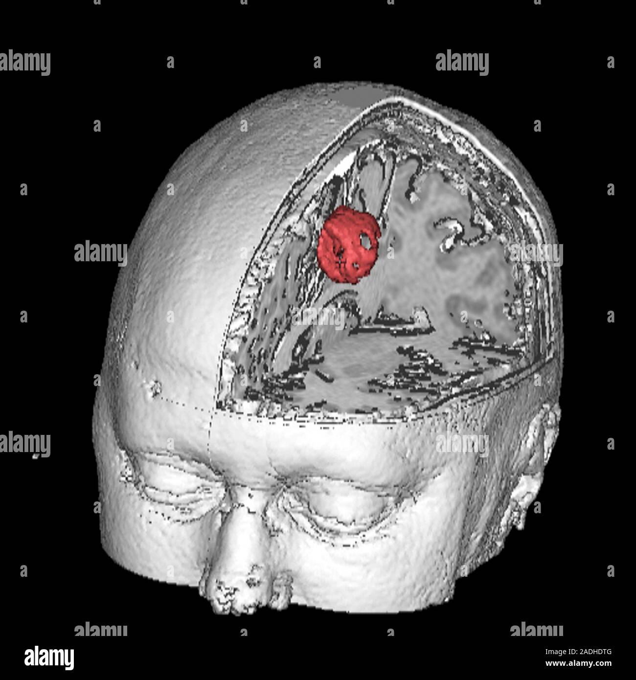 Tumeur au cerveau. Modèle à trois dimensions de couleur de la tête d'une femme de 43 ans ...