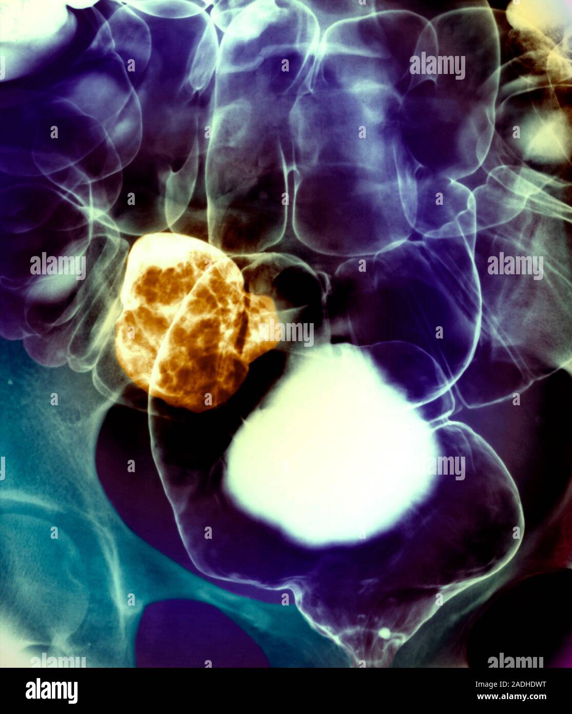 Le cancer du côlon. X-ray frontal couleur du gros intestin d'un patient ...