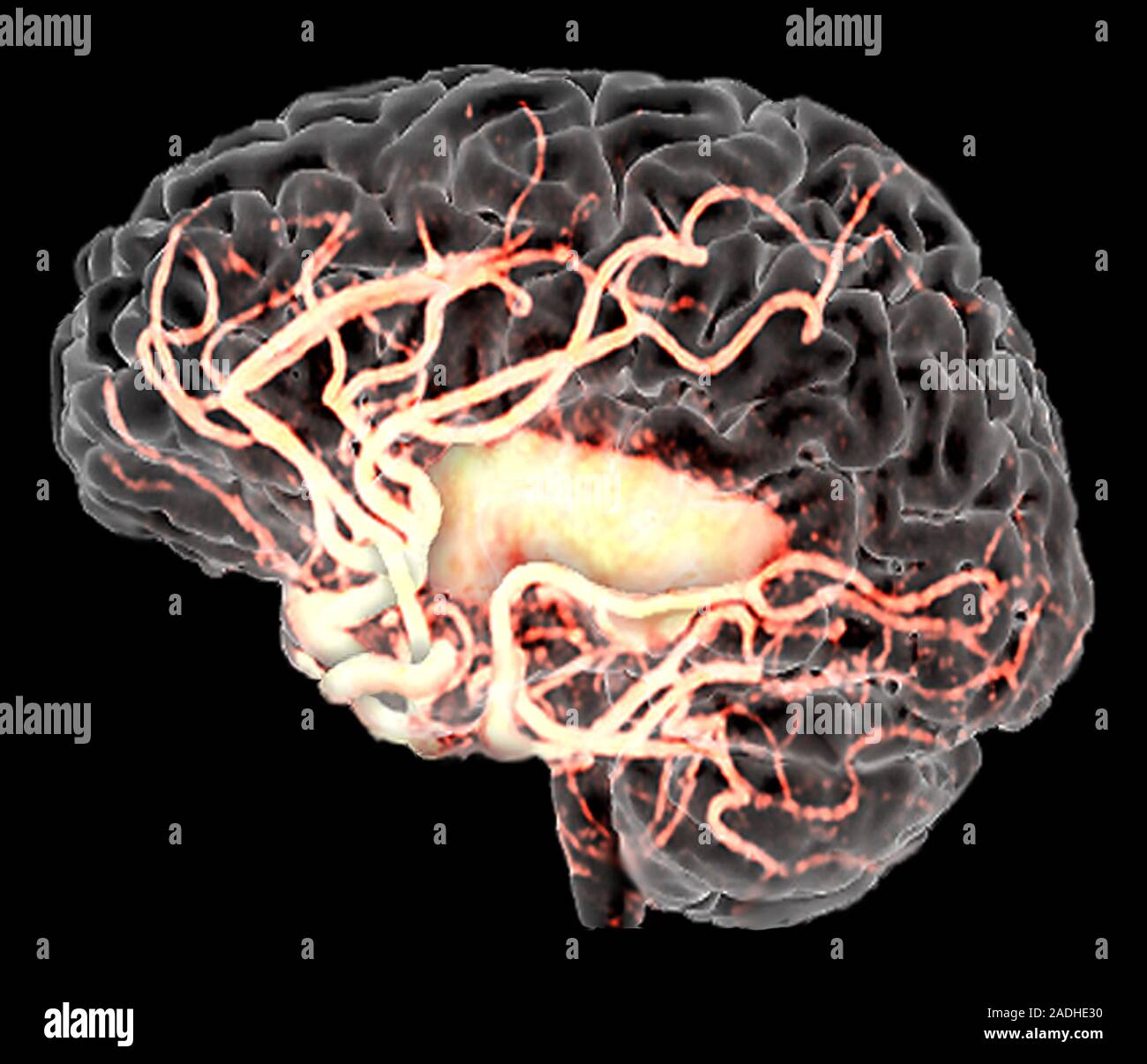 Les Accidents Vasculaires Cérébraux (AVC) Entraide ESI IDE - Documents