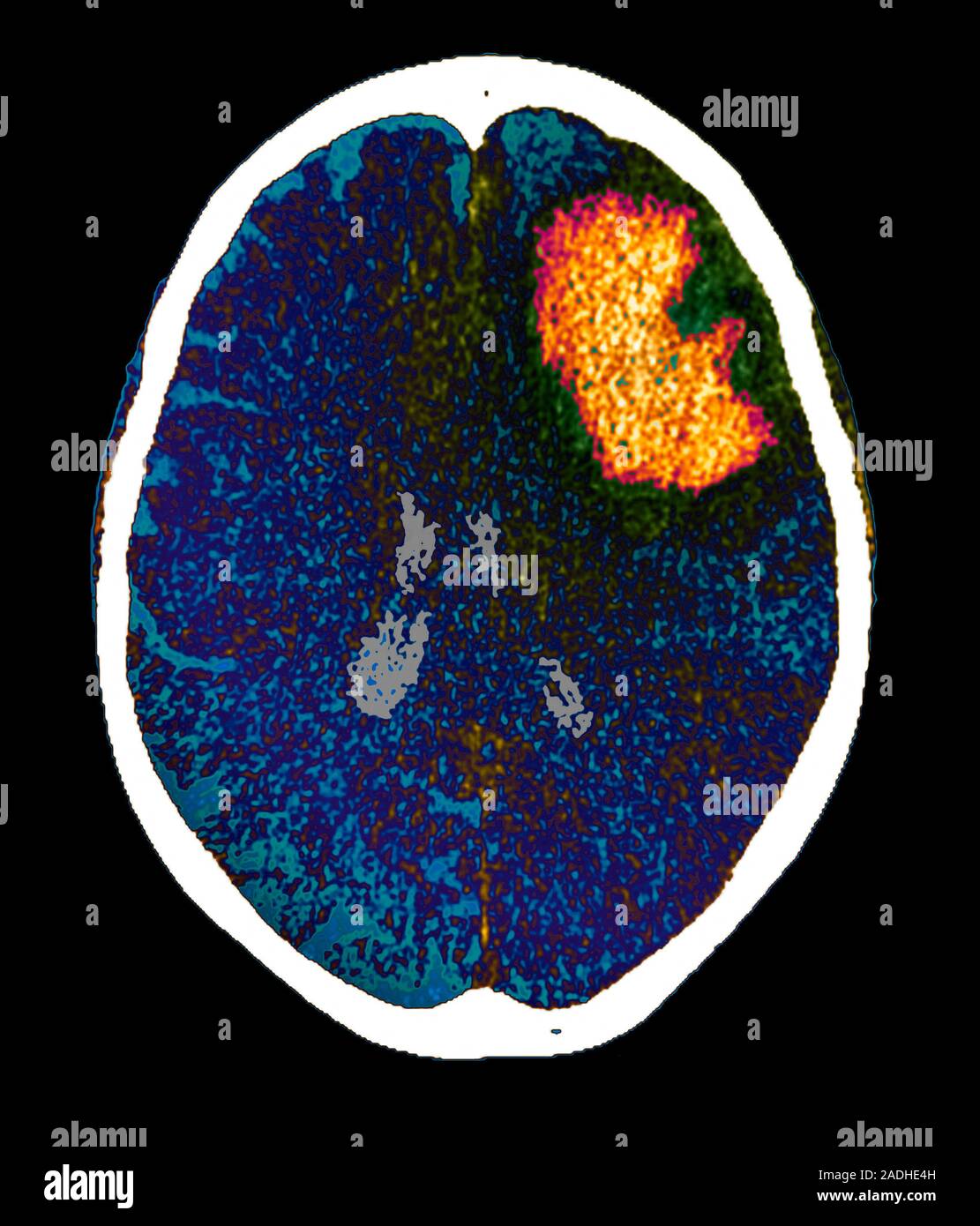 Hémorragie cérébrale. La tomographie de couleur (CT) d'une section à ...