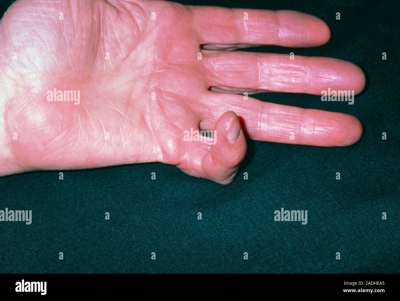 Dupuytrens contracture. Une main du patient montrant le petit doigt ...
