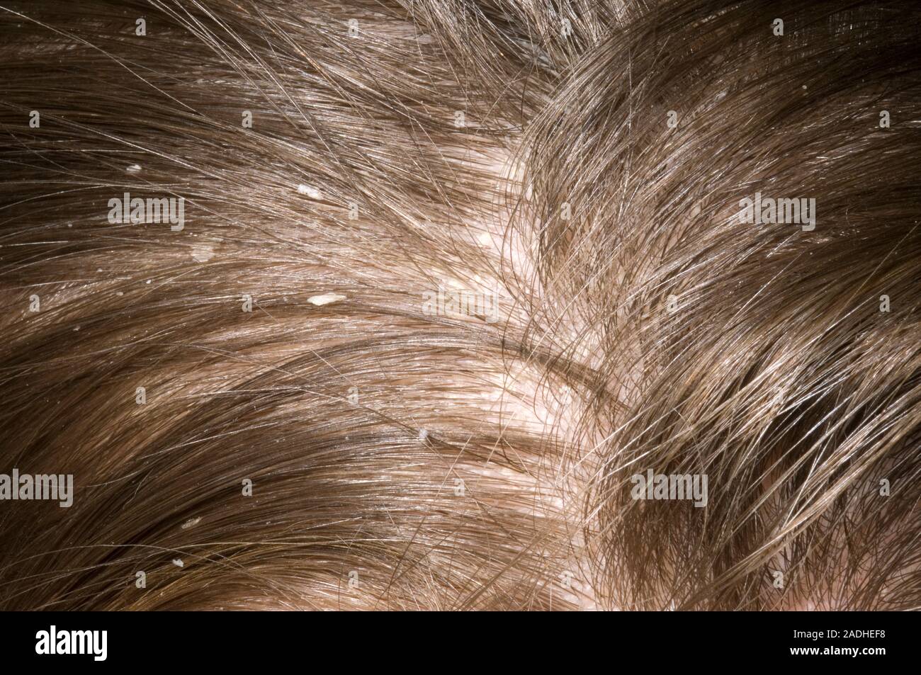 Capitis Seborrhoeic. Flocons de peau morte, ou des pellicules, dans les ...