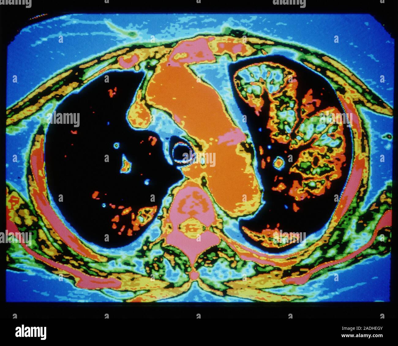 L'emphysème pulmonaire. Calculé en fausses couleurs tomo- graphie (CT ...