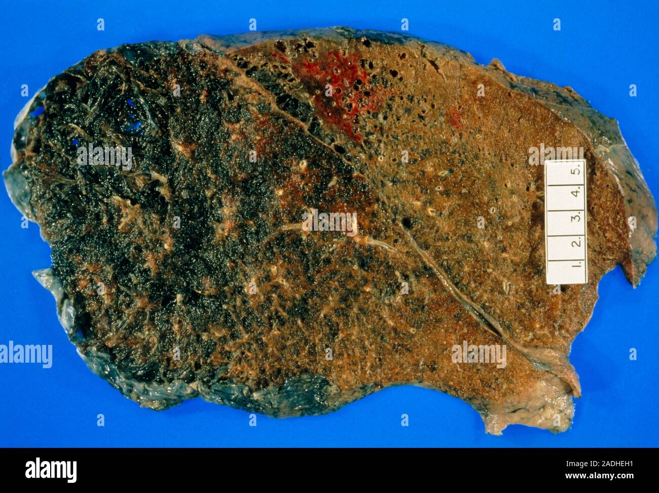 L'emphysème. Spécimen de tissu pulmonaire humain sectionné atteinte d ...