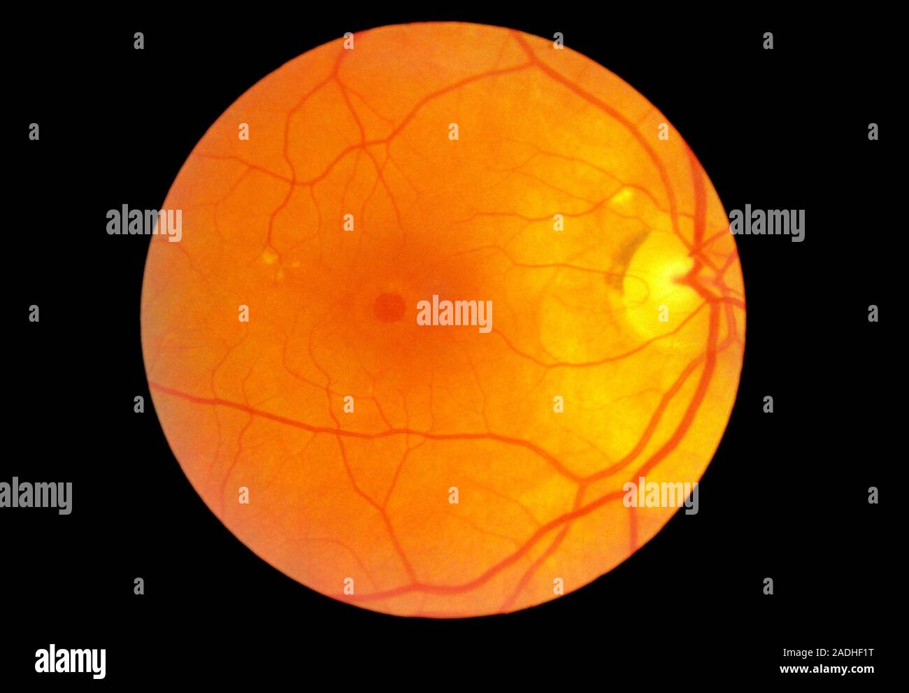 Trou maculaire. Vue de l'ophtalmoscope de la rétine de l'œil d'un ...