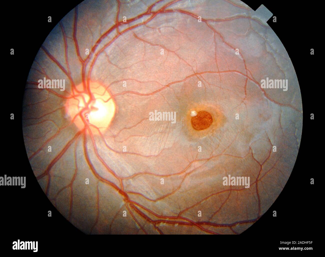 La rétinopathie solaire. Vue de l'ophtalmoscope de la rétine endommagée ...