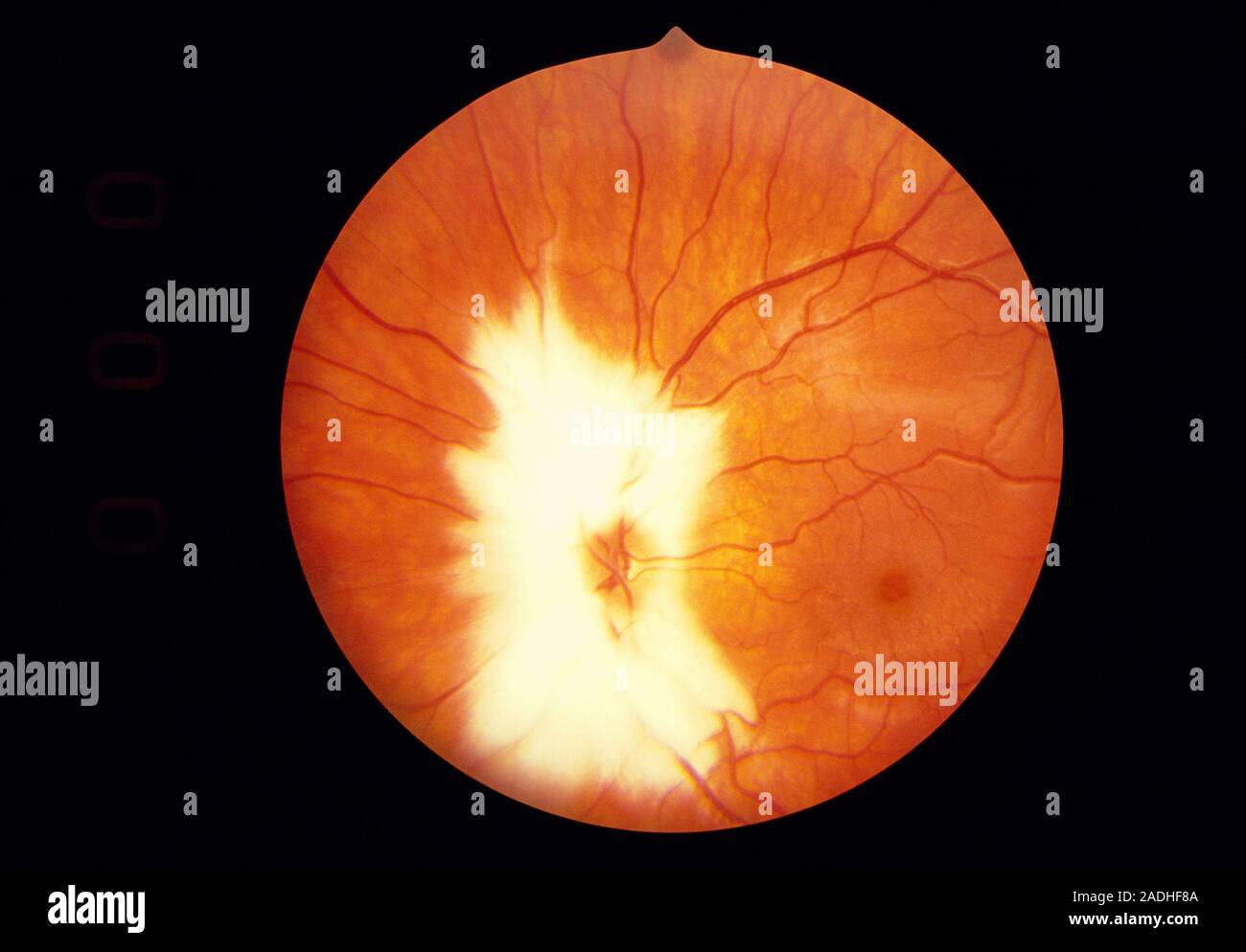 La myélinisation des nerfs dans le glaucome. L'image de l'ophtalmoscope ...