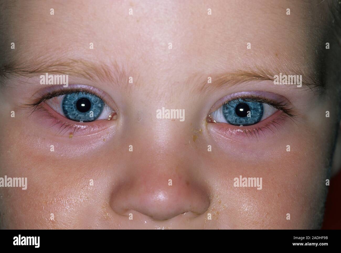 La conjonctivite virale des deux yeux d'un 1-année-vieux garçon. Les ...