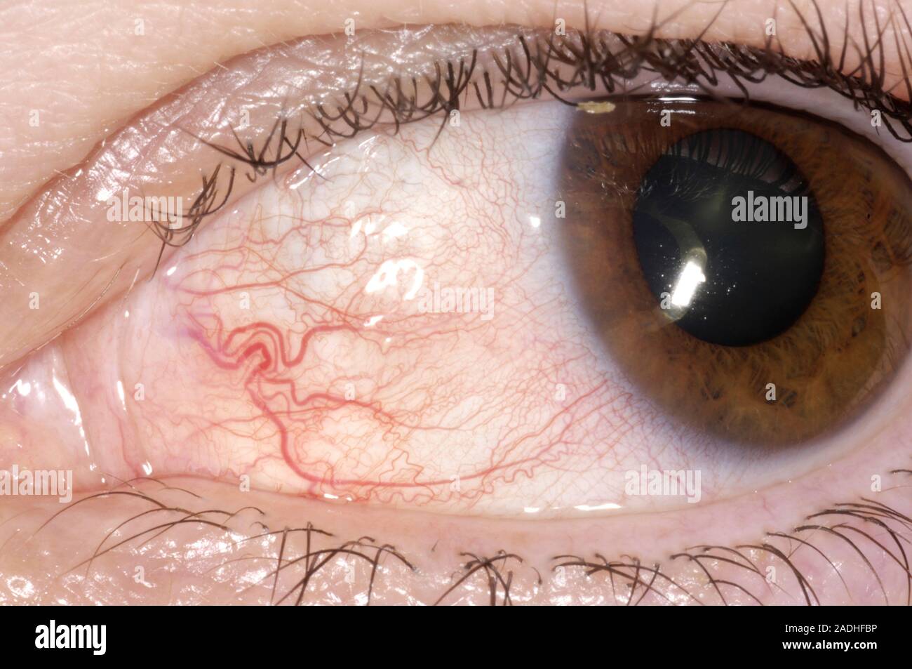 L'Episcleritis de l'oeil d'un homme de 47 ans. L'Episcleritis est l ...