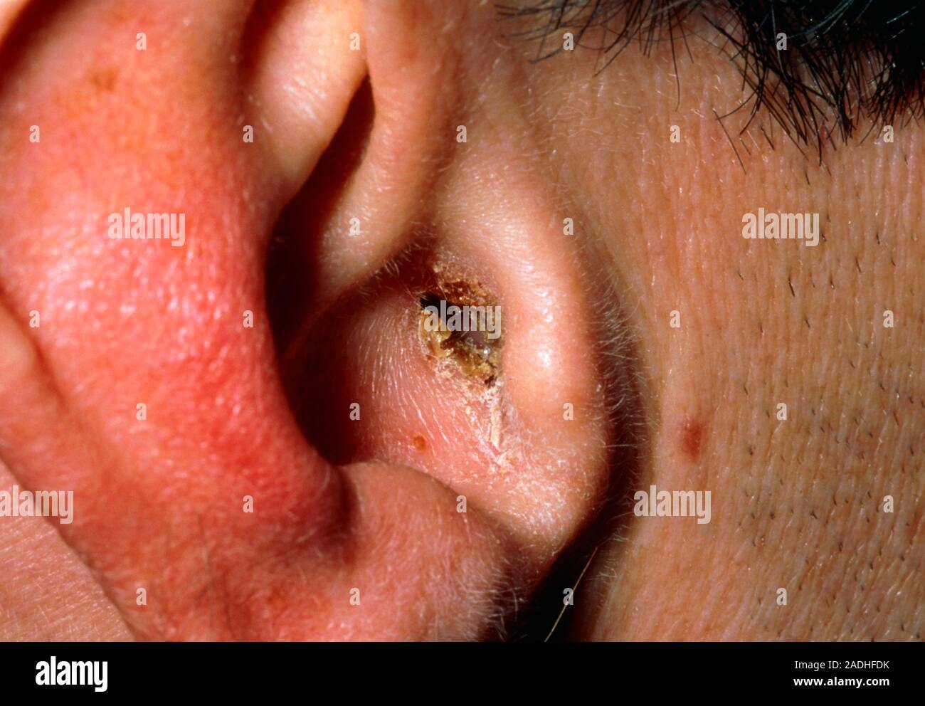 L'otite externe. Close-up de l'oreille d'un 36 ans male patient avec ...