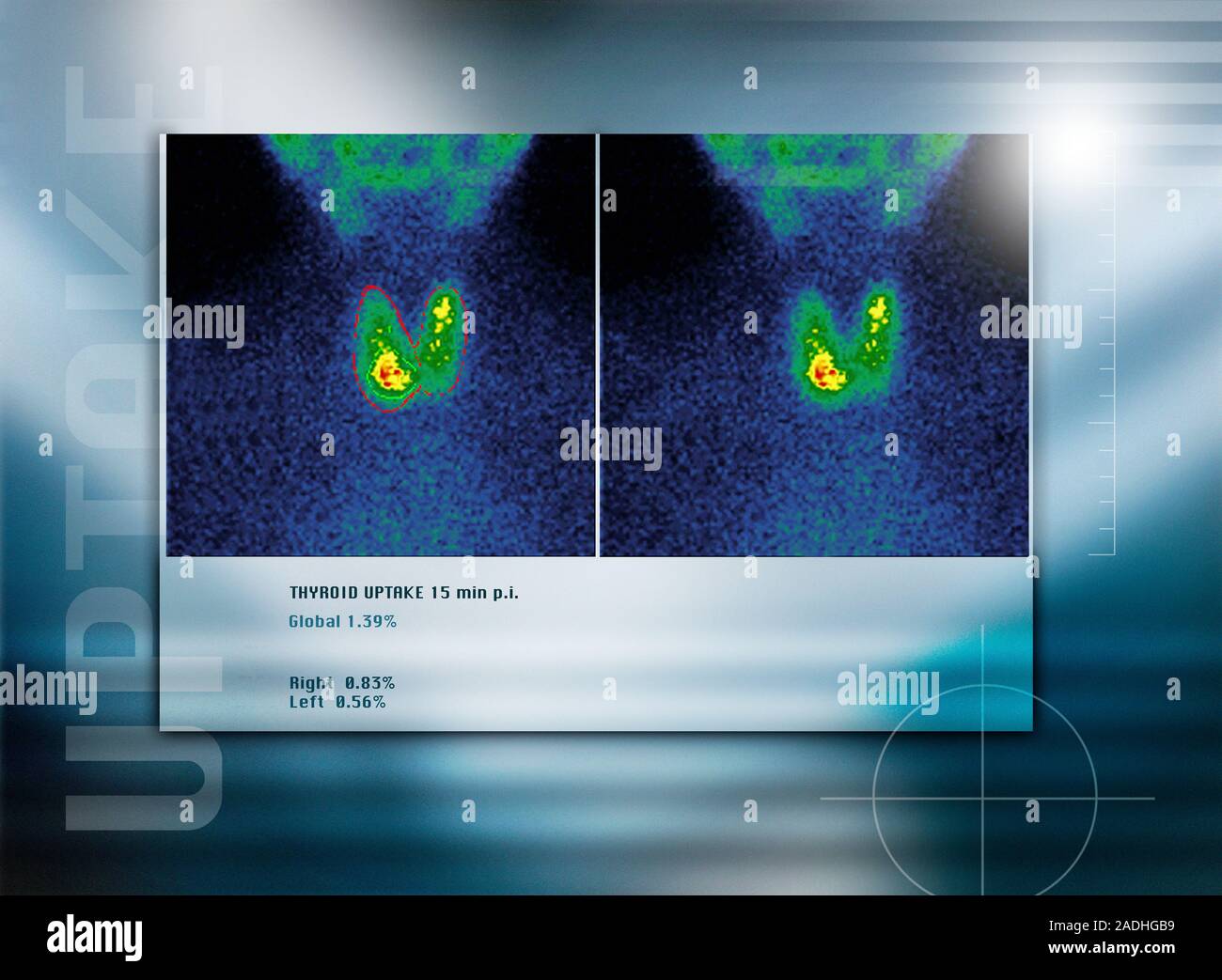 L'hyperthyroïdie, scintigraphie gamma-caméra couleur (scan). La ...