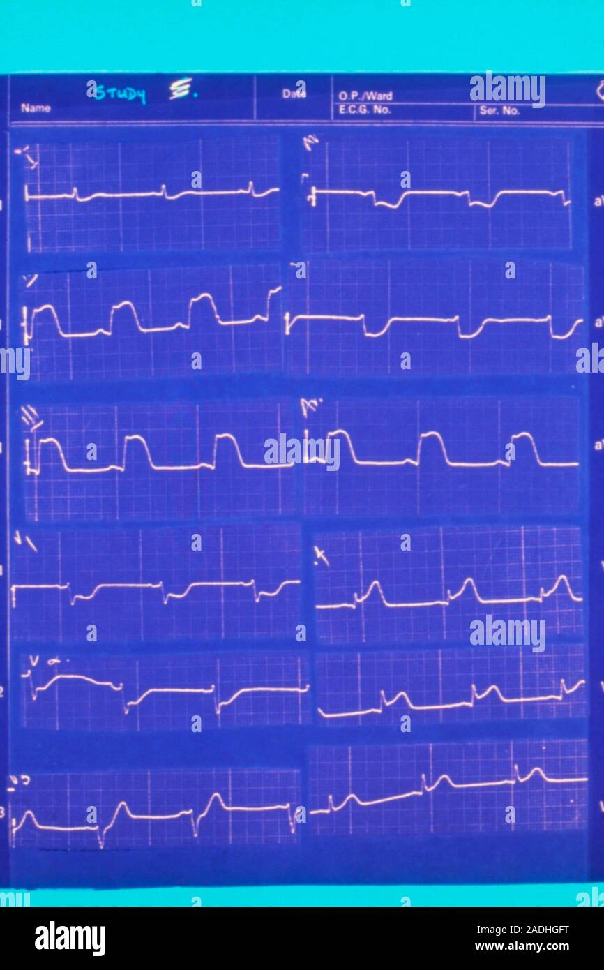 Électrocardiogramme (ECG) modèle d'une personne souffrant d'un ...
